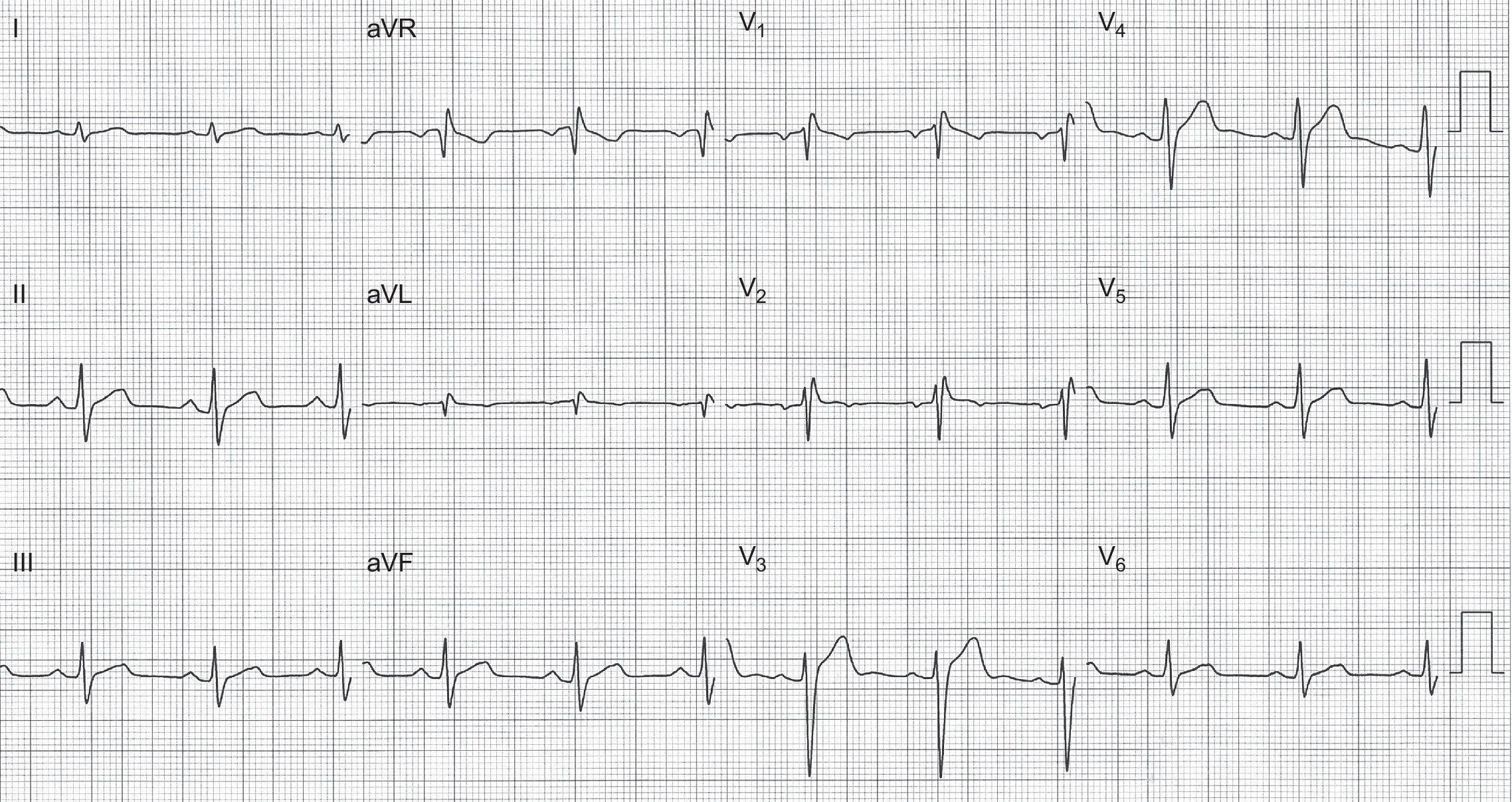 ECG de septiembre de 2014 | Revista Española de Cardiología