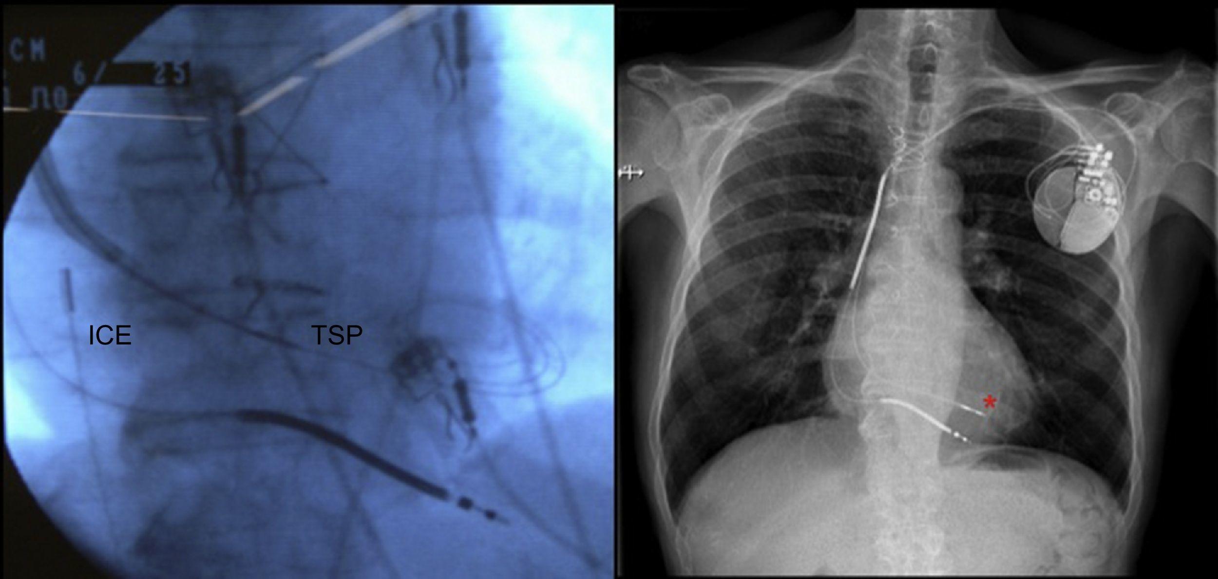 Temas de actualidad en arritmias y estimulación cardiaca | Revista ...