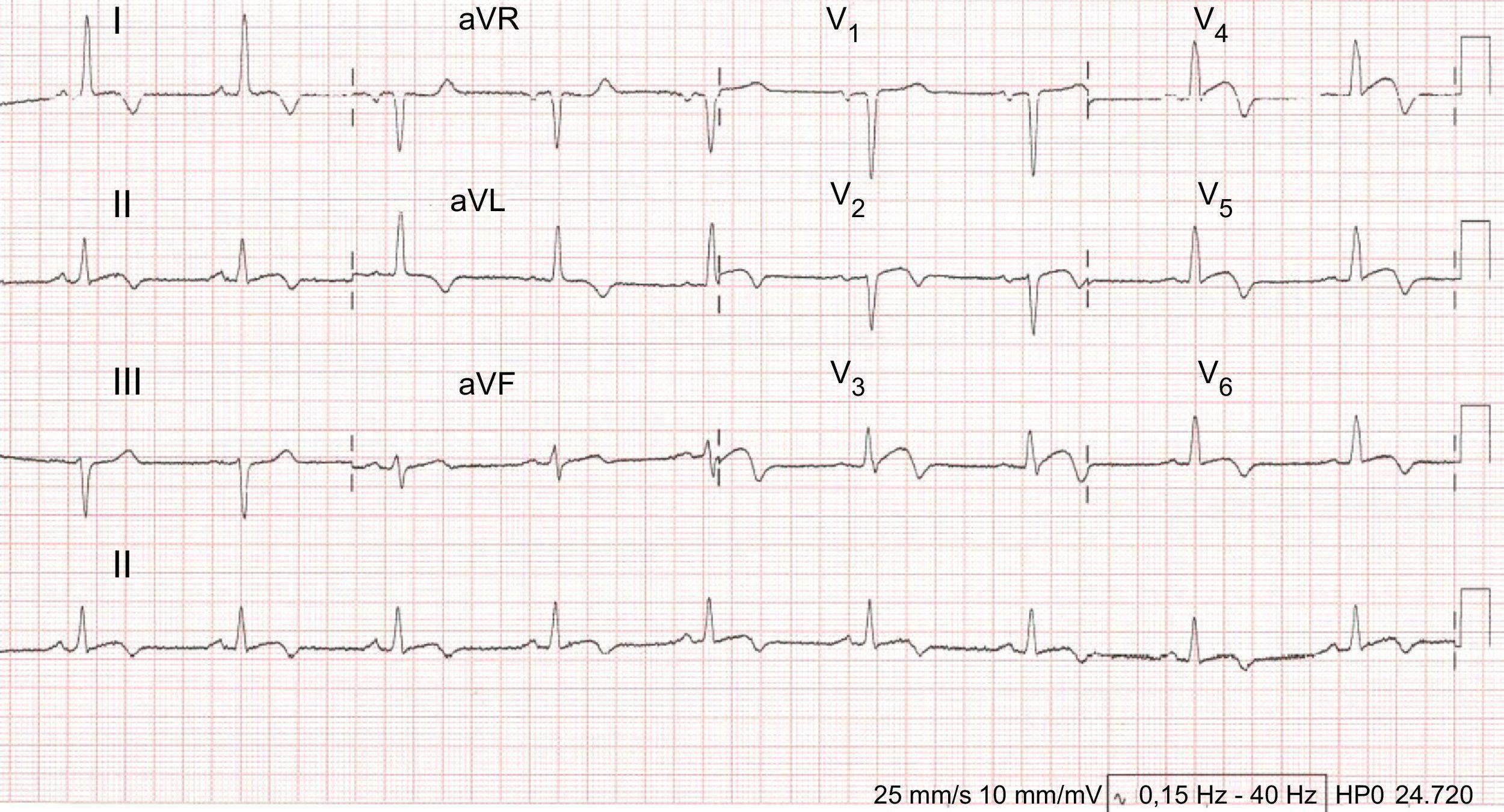 ECG de octubre de 2016 | Revista Española de Cardiología