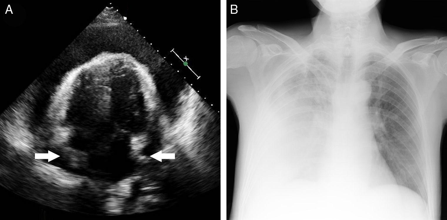 Pericarditis recurrente como presentación en enfermedad de Still del ...
