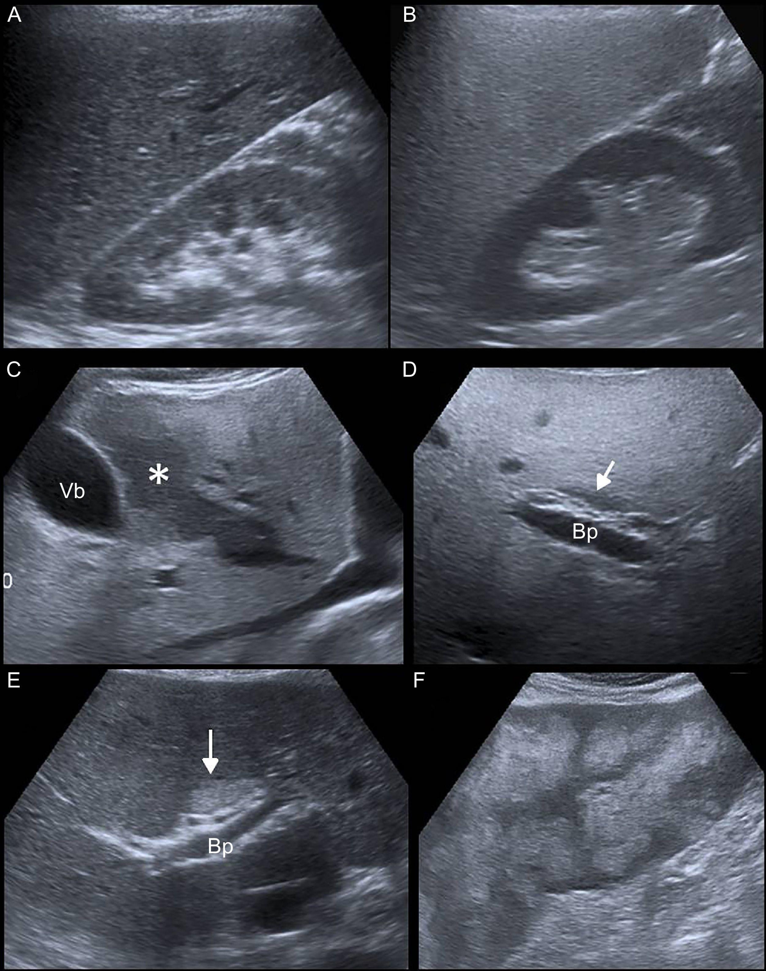 Hígado y enfermedad cardiovascular: lo que el cardiólogo debería ...