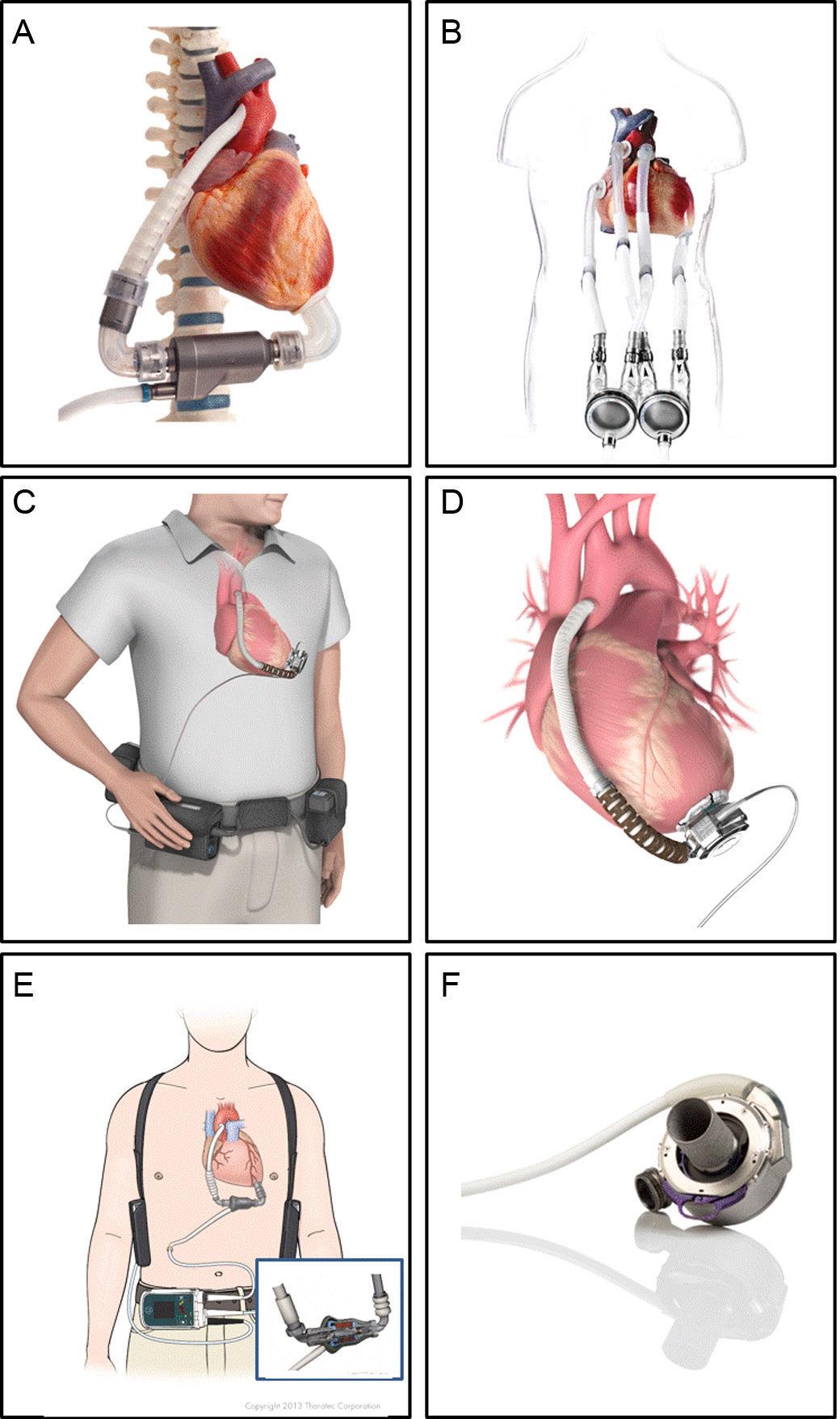 Trasplante cardiaco y soporte circulatorio mecánico para pacientes con ...