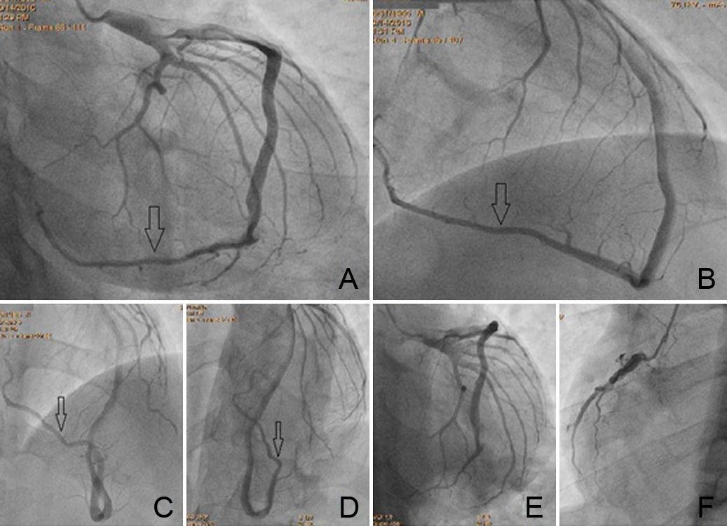 Arteria coronaria descendente anterior superdominante | Revista ...