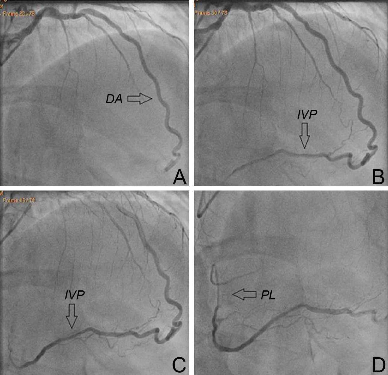 Arteria coronaria descendente anterior superdominante | Revista ...