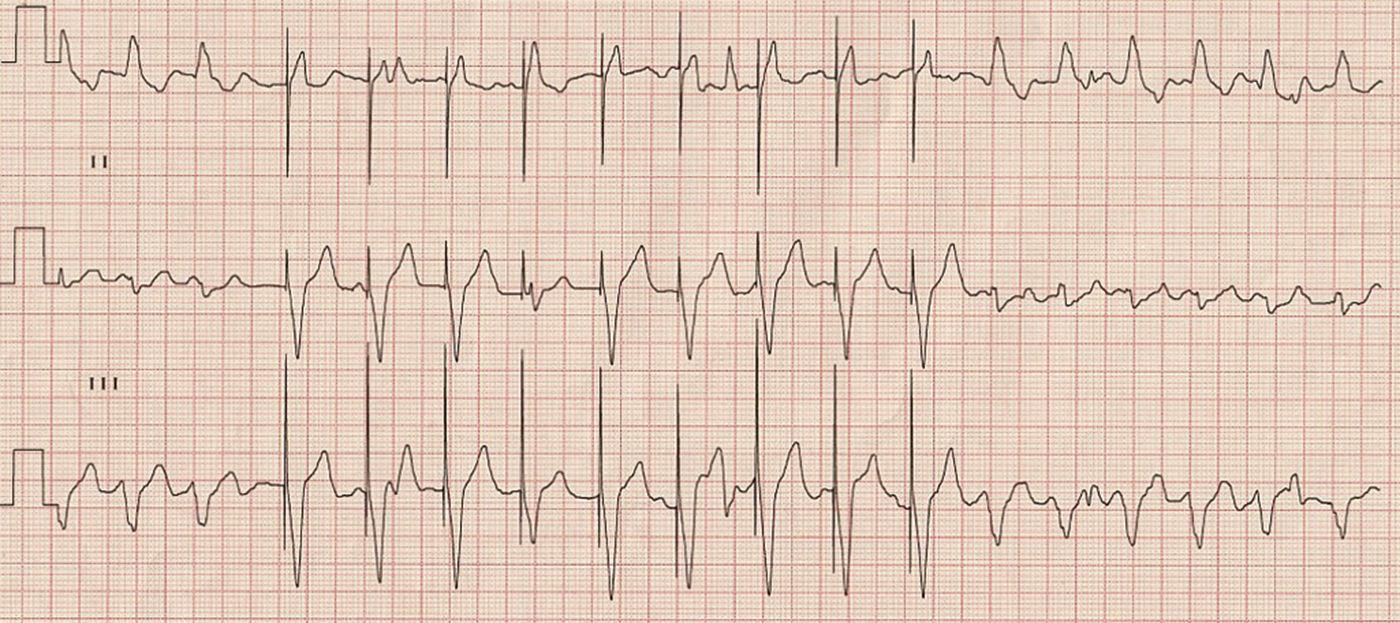 ECG de noviembre de 2017 | Revista Española de Cardiología