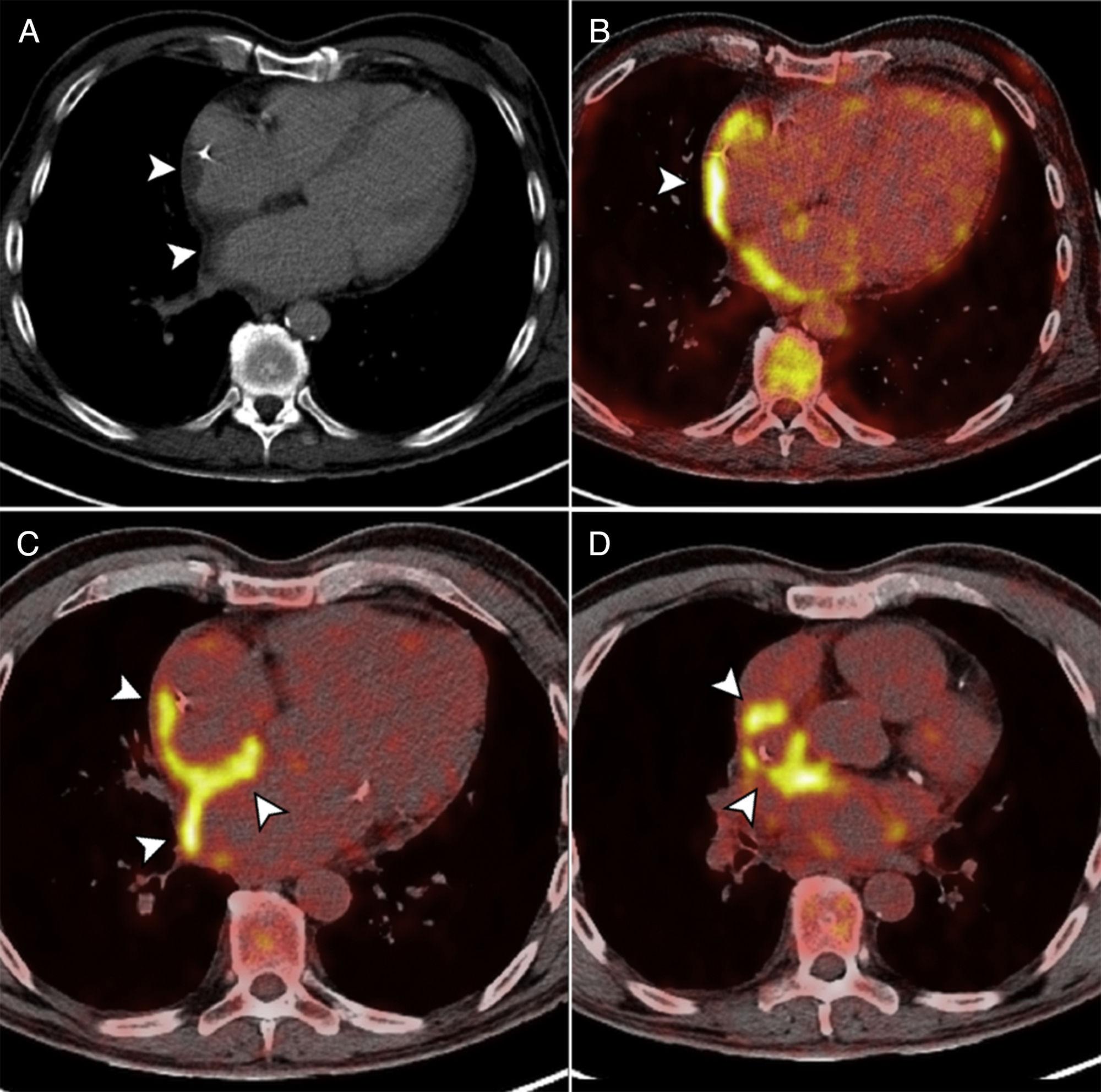 Papel de la PET/angio-TC para evaluar dispositivos intracardiacos ...