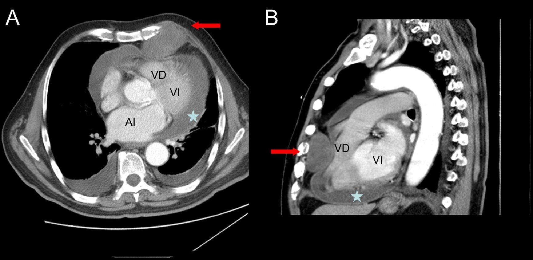 Condrosarcoma: compresión extrínseca del ventrículo derecho y derrame ...