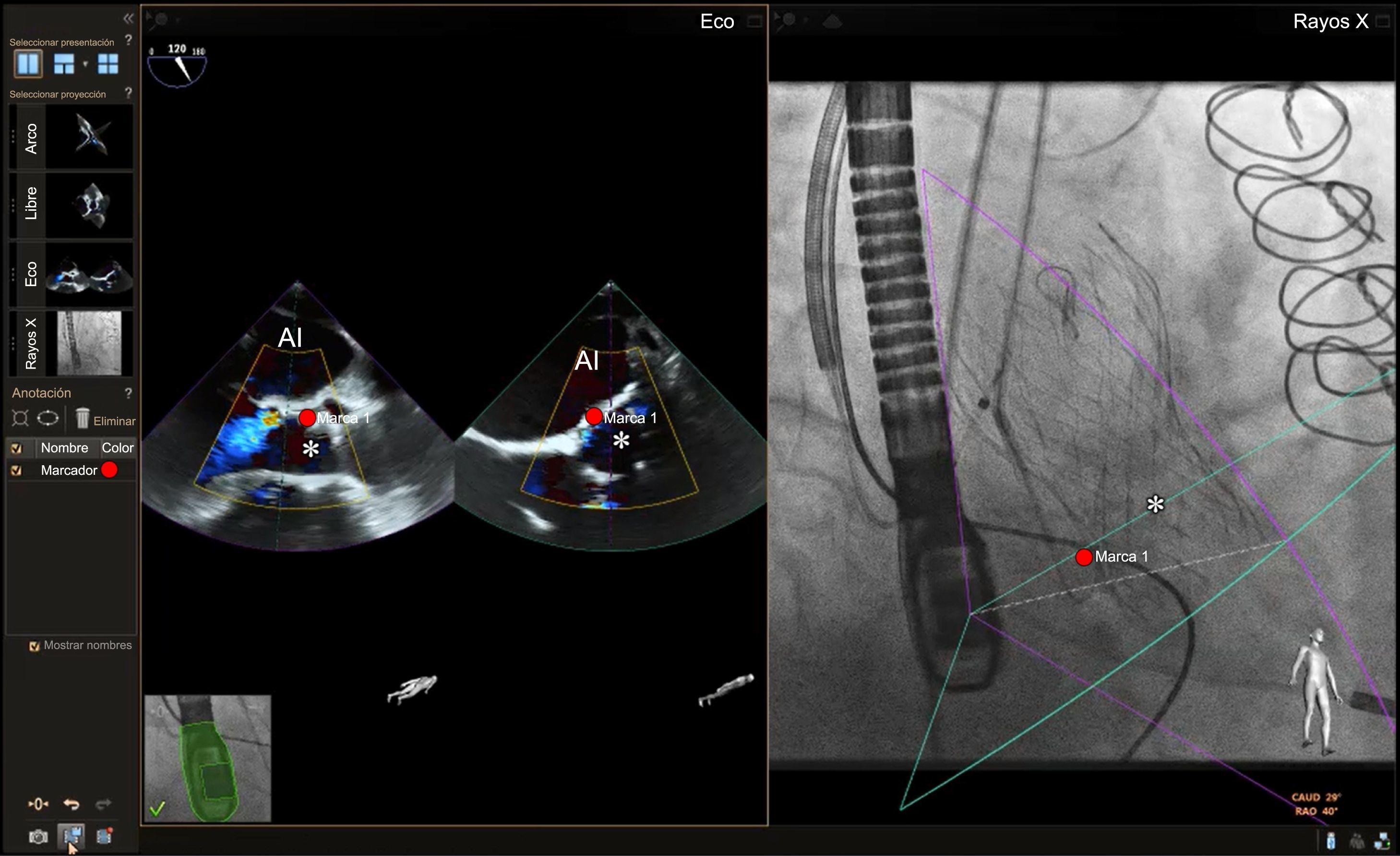 Técnicas de fusión de imagen en los procedimientos intervencionistas ...