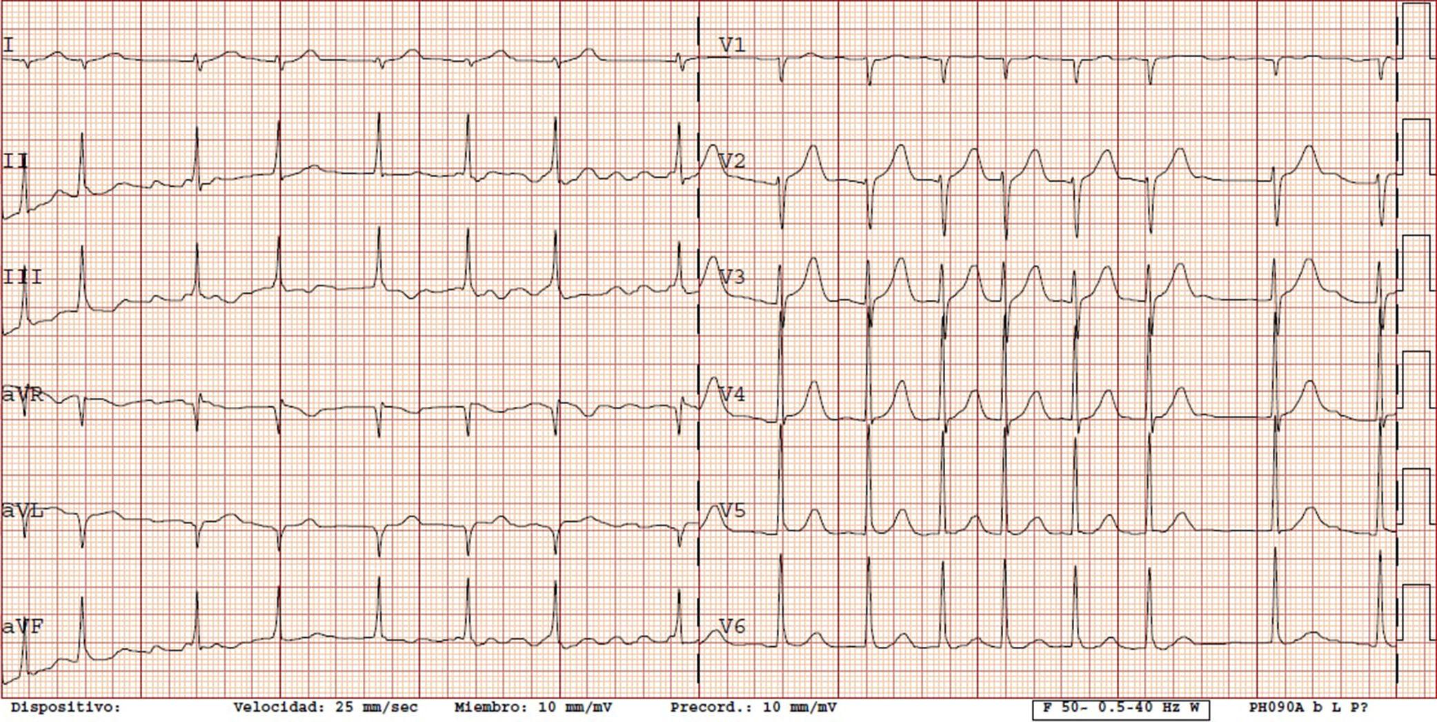 Respuesta al ECG de marzo de 2019 | Revista Española de Cardiología