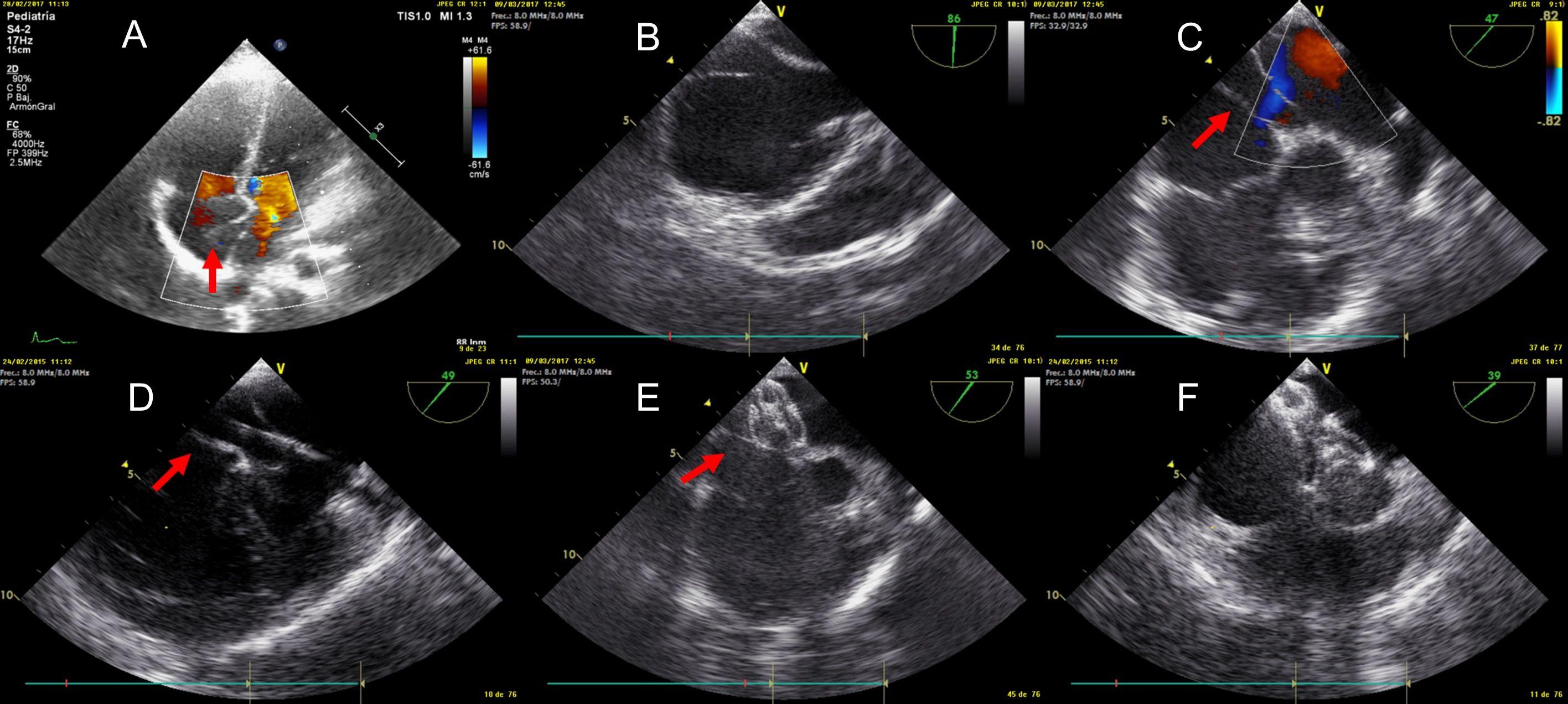 Cor triatriatum dexter incompleto: un invitado incómodo en el cierre ...