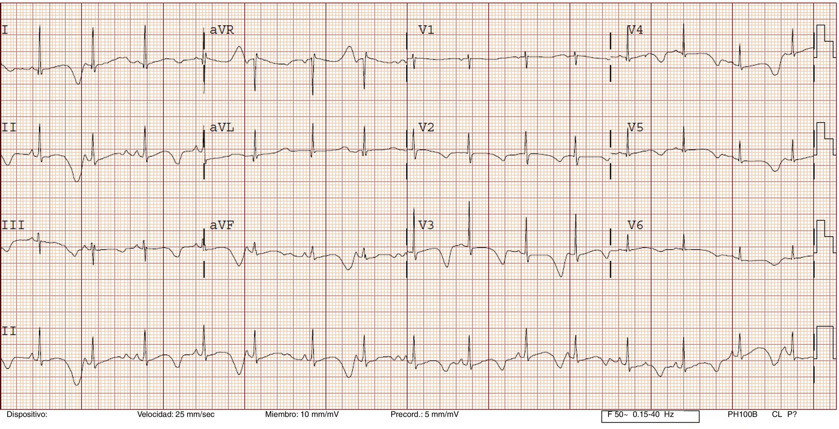ECG de diciembre de 2019 | Revista Española de Cardiología