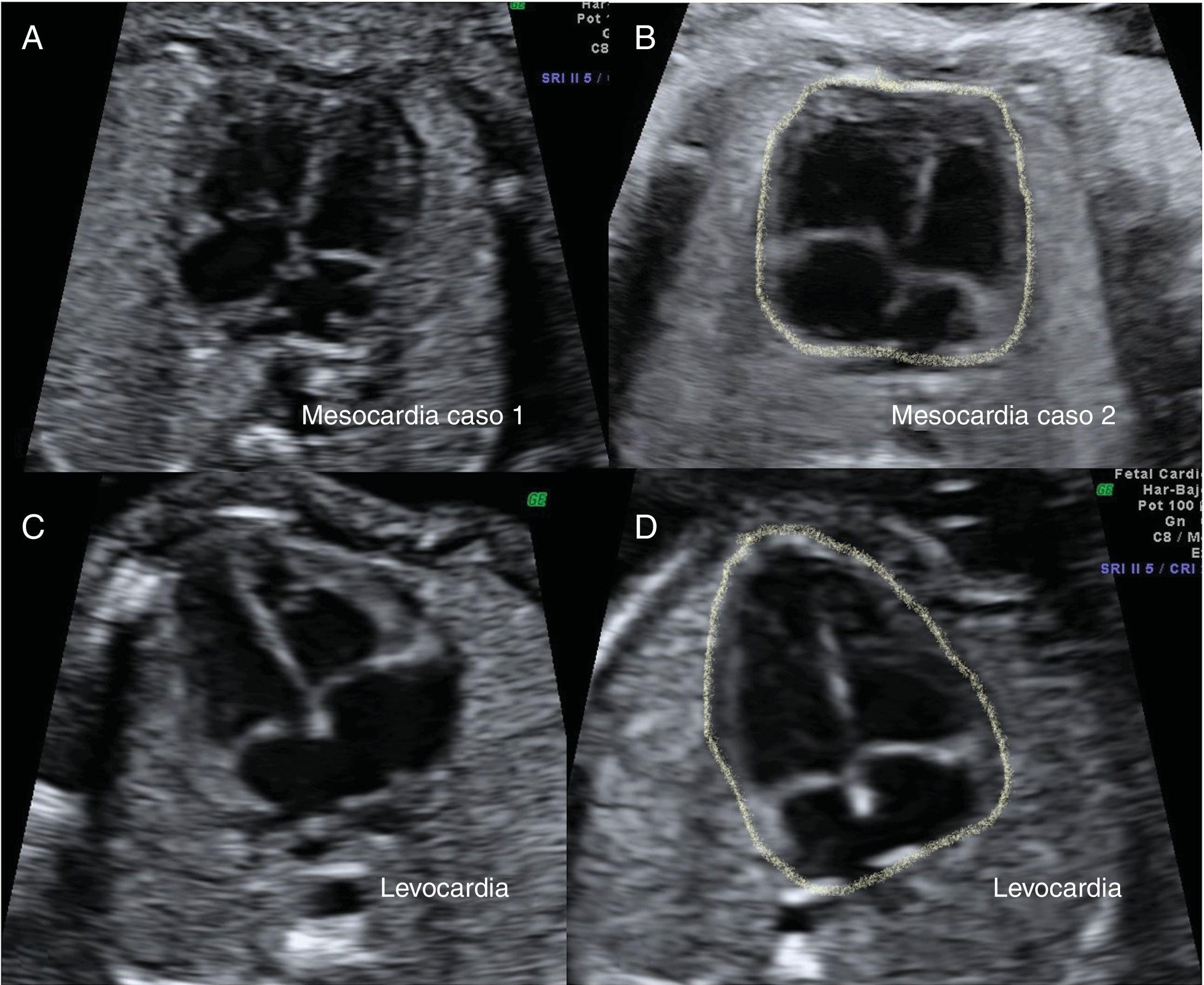 Características ecocardiográficas de la mesocardia fetal: un corazón ...