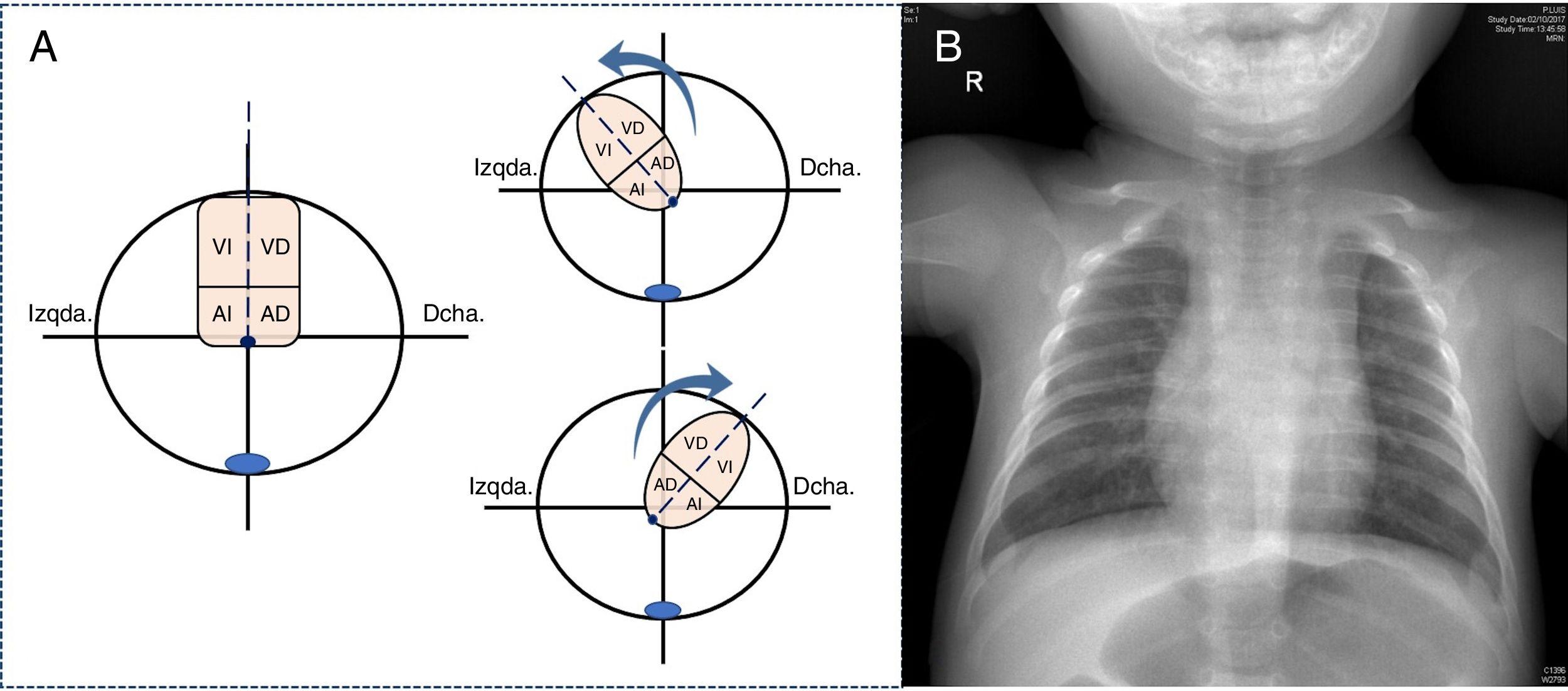 Características ecocardiográficas de la mesocardia fetal: un corazón ...