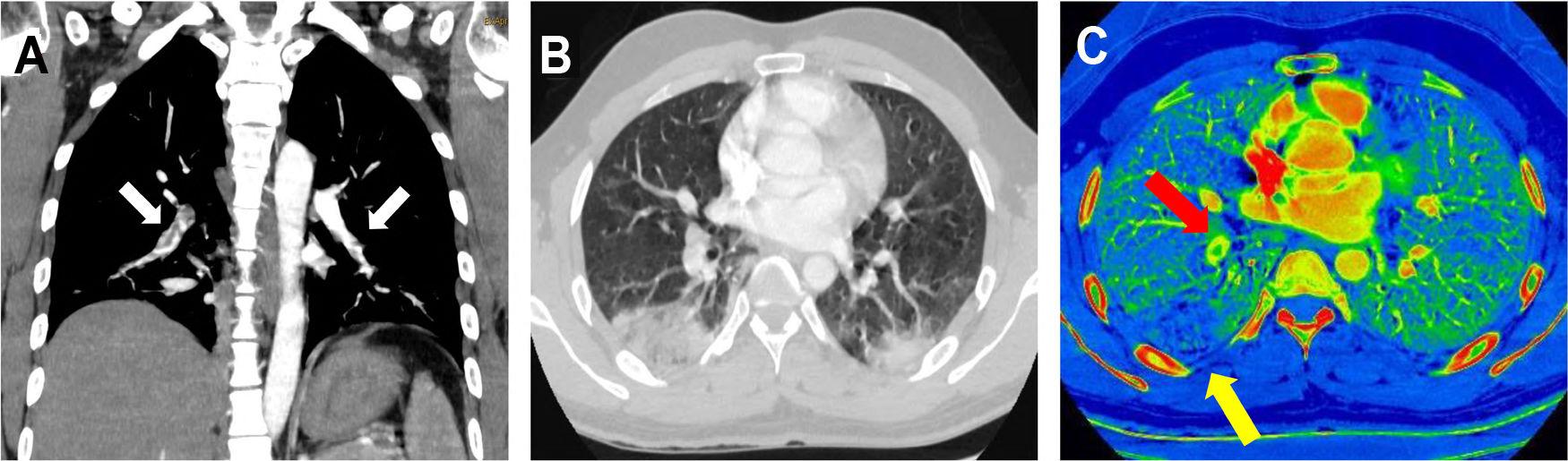 Infarto pulmonar secundario a tromboembolia pulmonar en COVID-19 ...