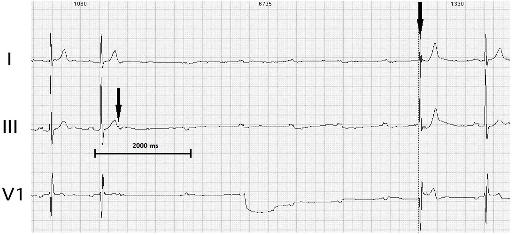 Respuesta al ECG de noviembre de 2020 | Revista Española de Cardiología