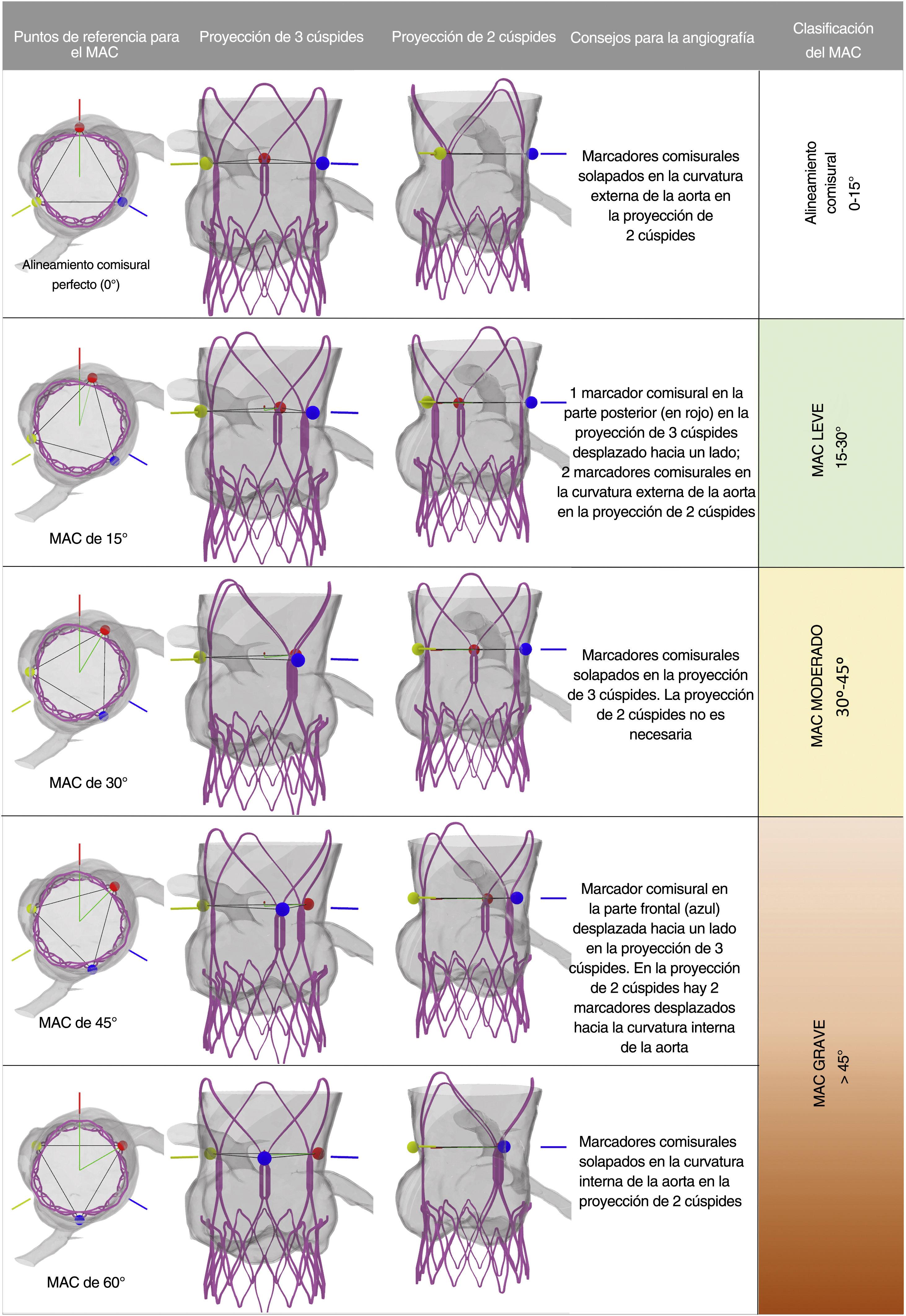 Método para la evaluación angiográfica del alineamiento comisural tras ...