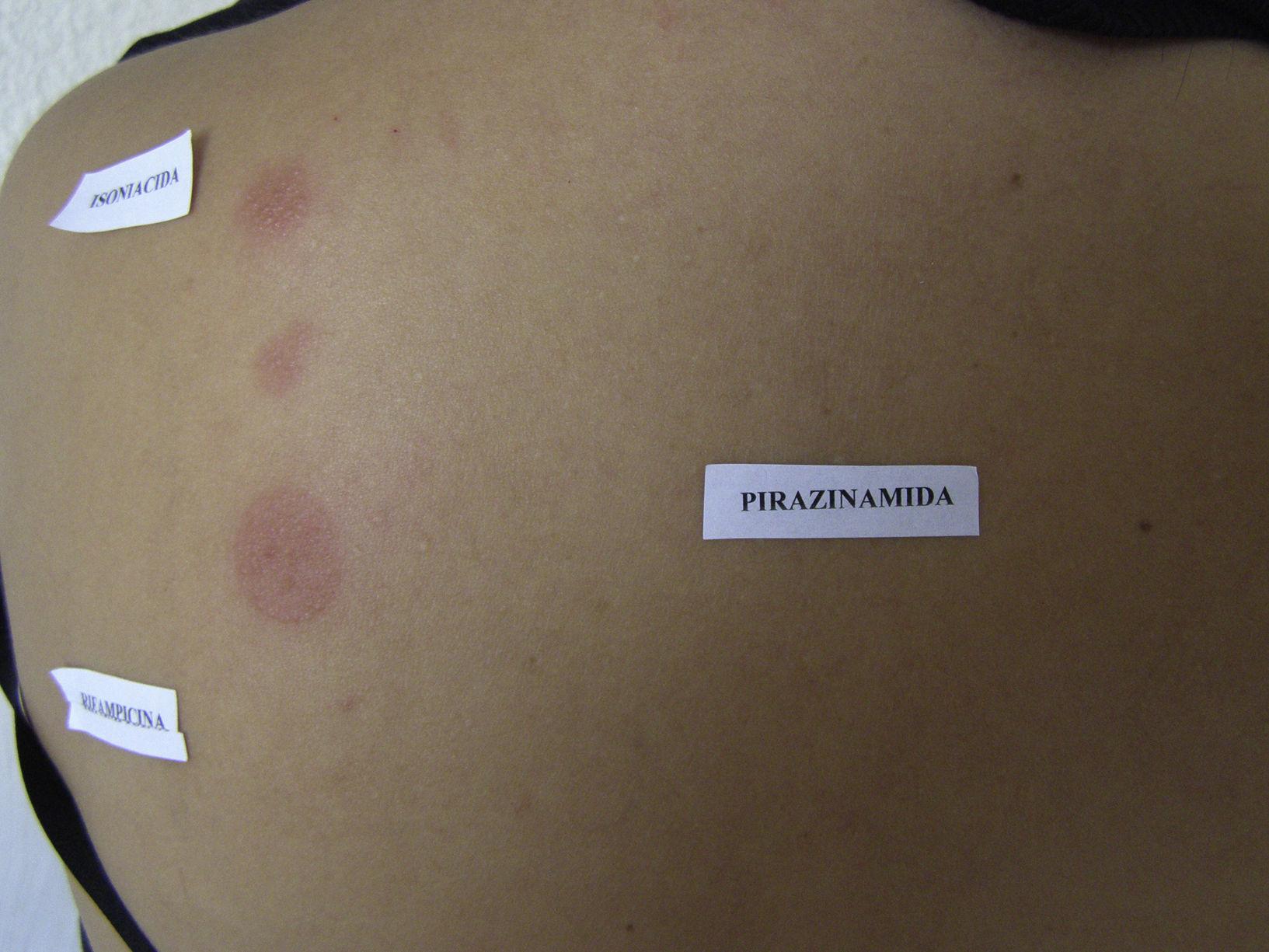 Isoniazid hepatitis: are immunological mechanisms implicated ...