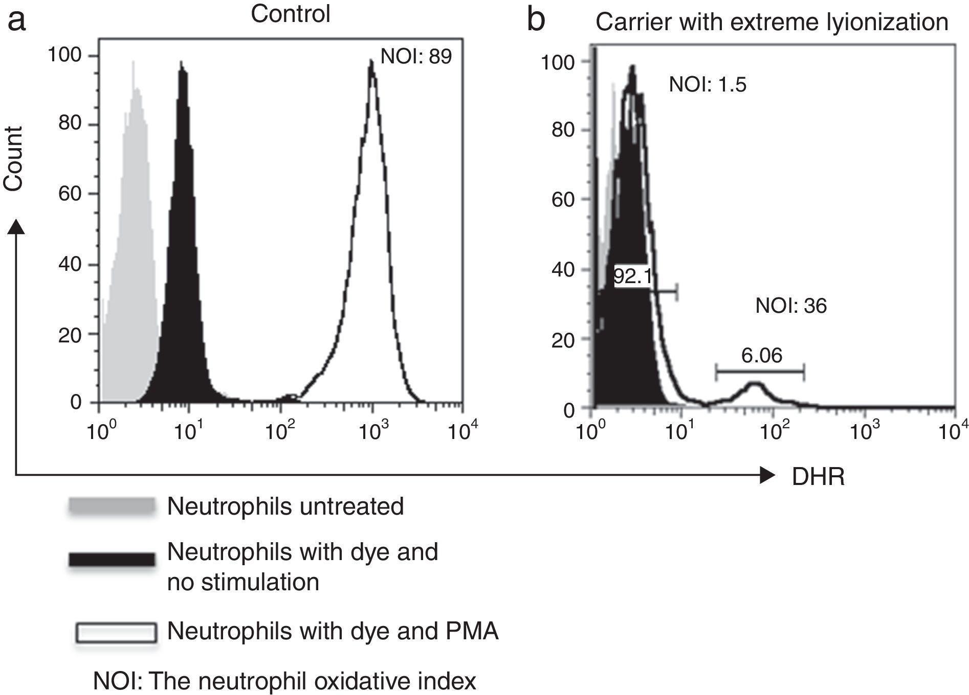 Detection of inheritance pattern in thirty-three Mexican males with ...