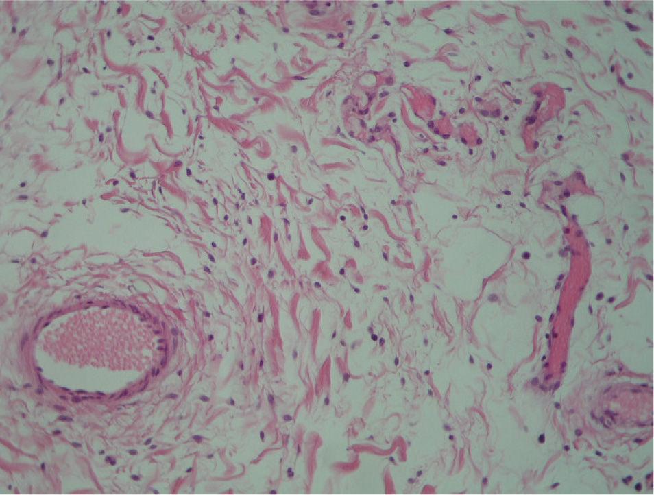 Angiomixoma agresivo vulvar | Progresos de Obstetricia y Ginecología