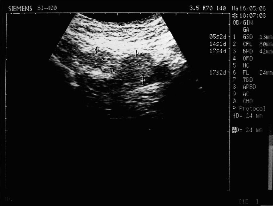 Hallazgos ecográficos extragenitales en la urgencia ginecológica ...