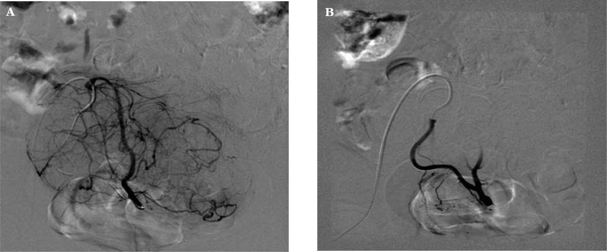 Embolización de las arterias uterinas en el tratamiento del mioma ...