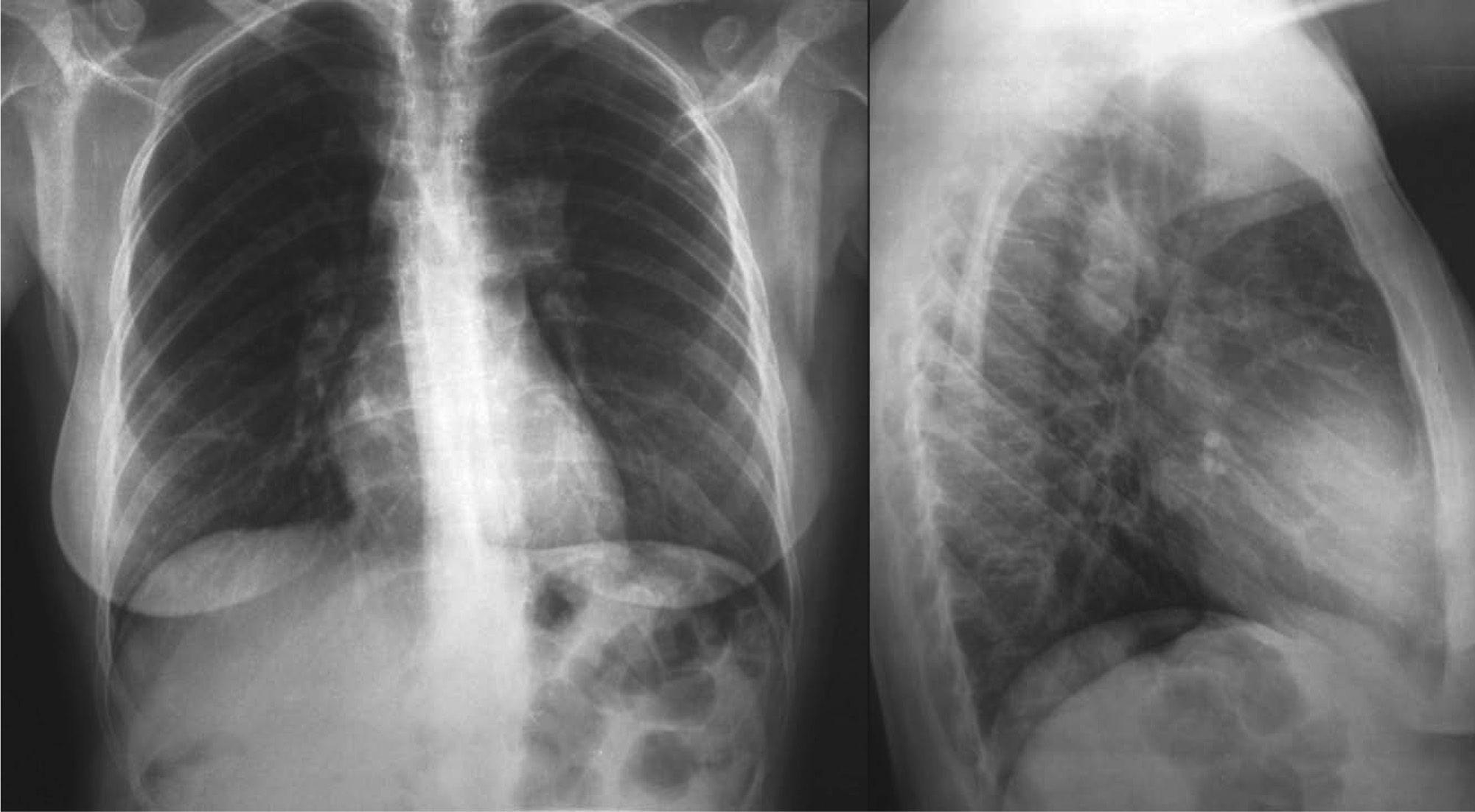 Adenocarcinoma de pulmón en gestante | Progresos de Obstetricia y ...
