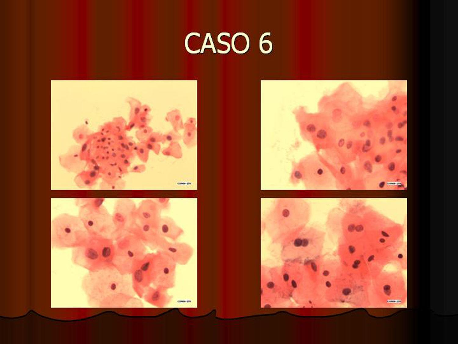 Papel de p16 en lesiones preinvasivas e invasivas de cáncer de cuello ...