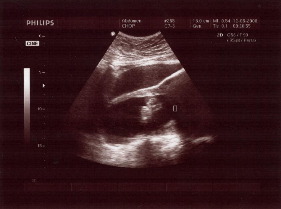 Cerclaje cervical de emergencia: nuestra experiencia | Progresos de ...