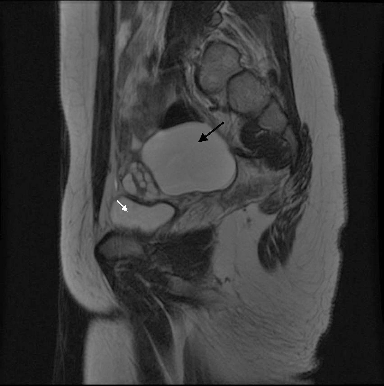 Quiste paratubárico en la infancia. Manejo laparoscópico | Progresos de ...