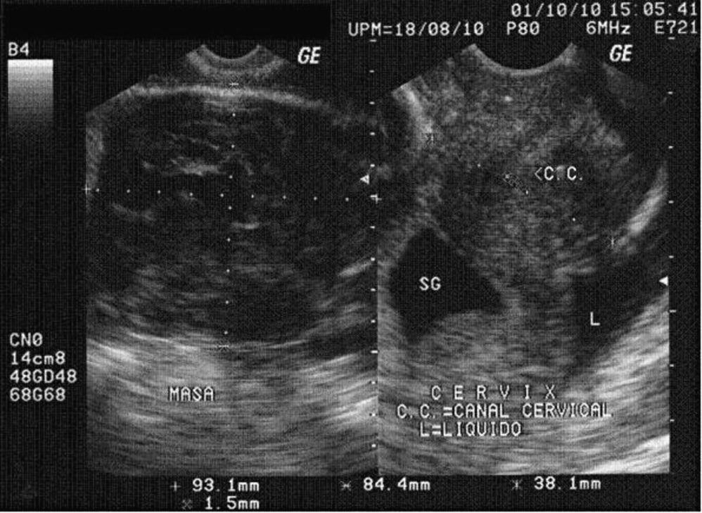 Embarazo heterotópico espontáneo en pacientes con antecedente de ...