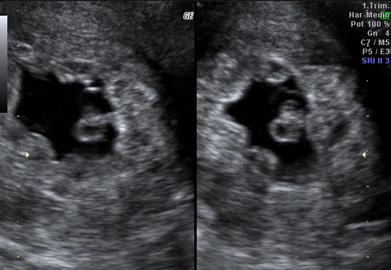 Tratamiento médico de la gestación ectópica cervical: Nuevos avances ...
