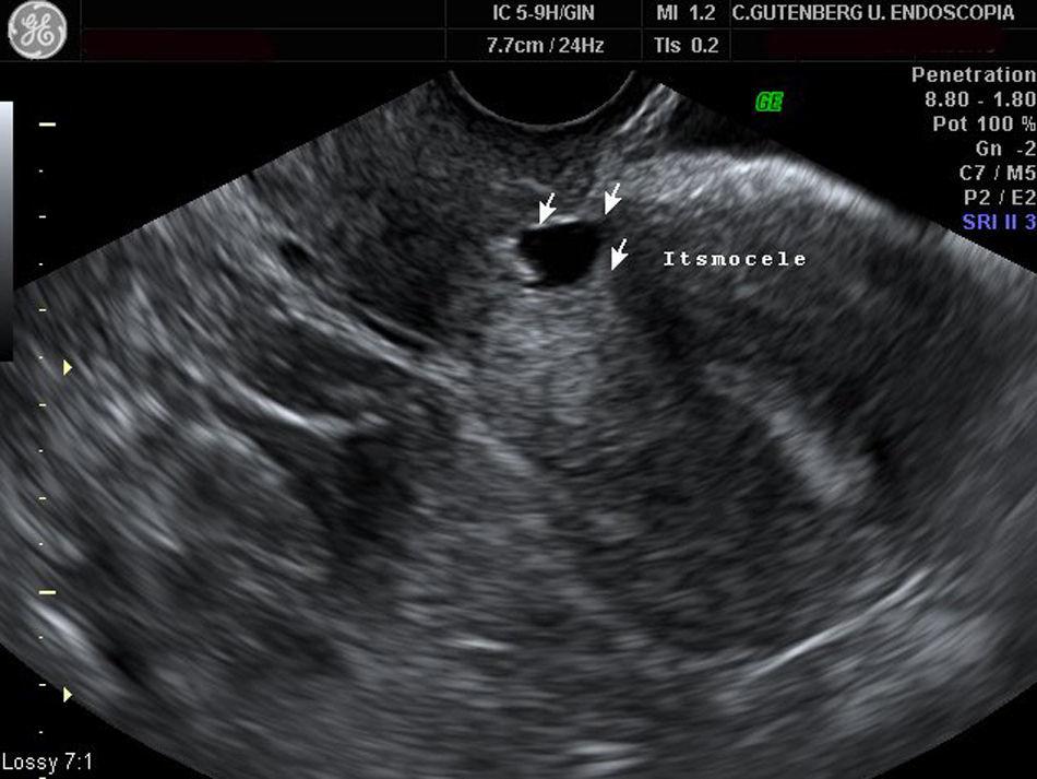 Cirugía histeroscópica del istmocele: ¿solución a un viejo problema ...