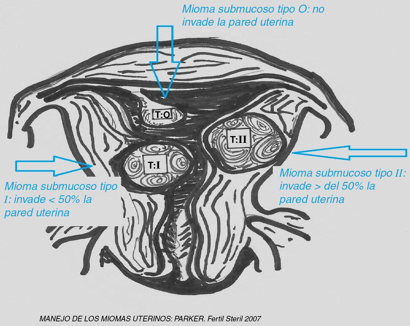 Miomas uterinos (actualizado febrero del 2013) | Progresos de ...