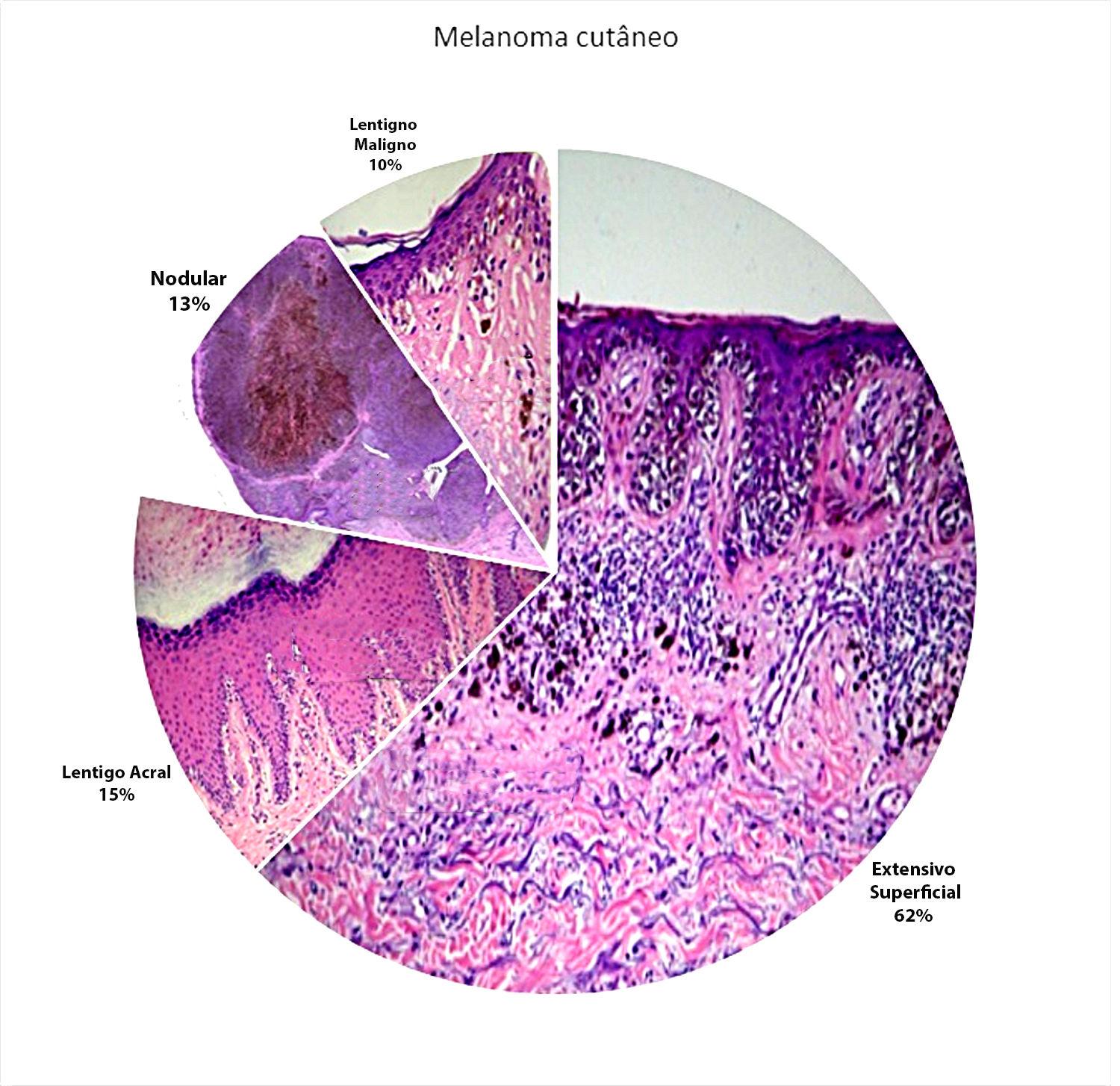 Lentigo Maligna Melanoma Histology