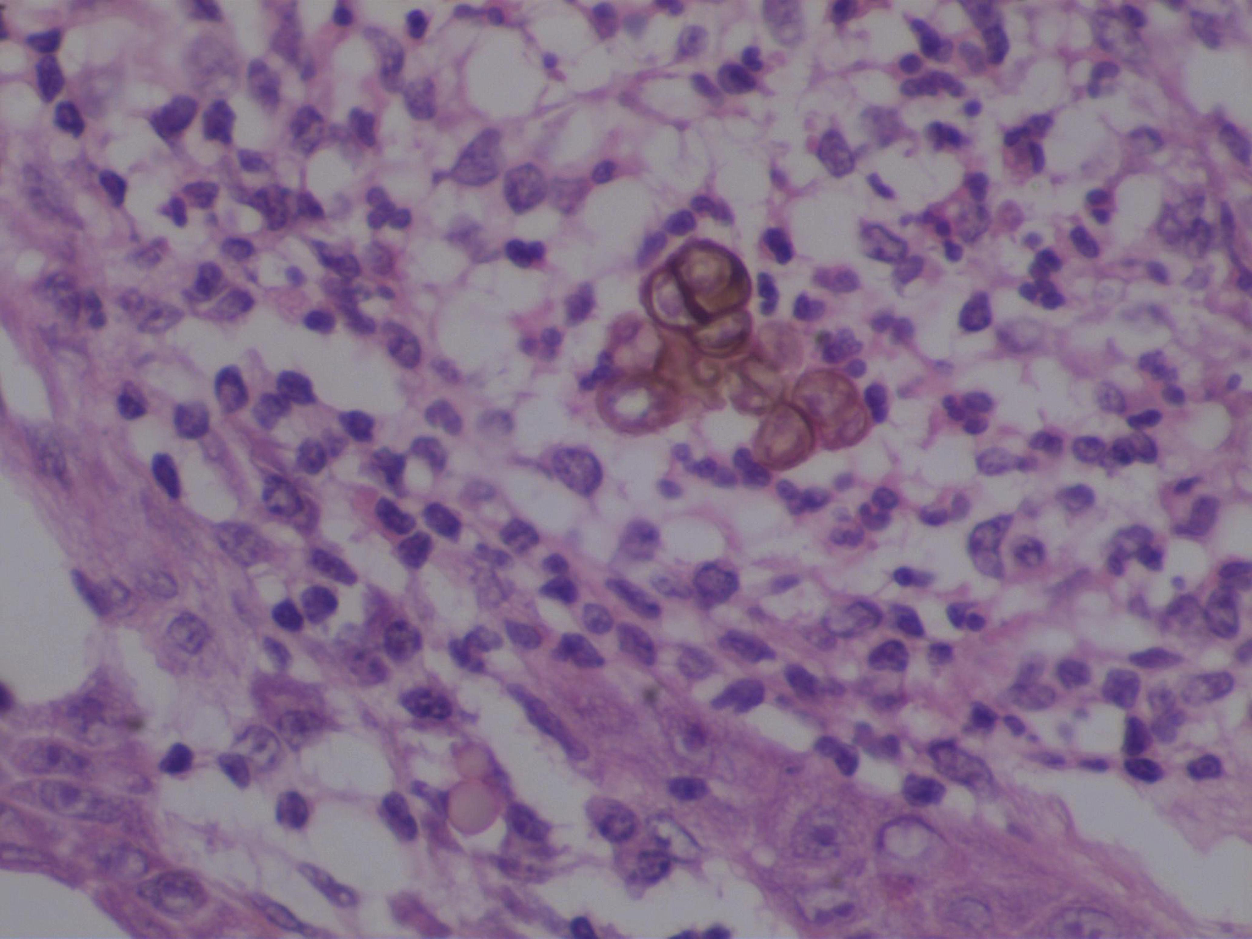 Chromoblastomycosis due to Cladosporium langeronii. Molecular diagnosis ...