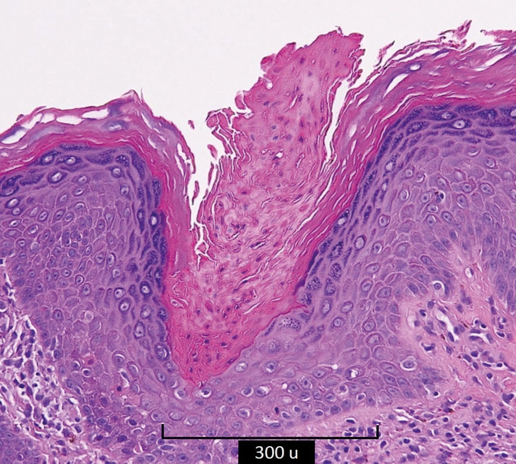 Generalized linear porokeratosis* | Anais Brasileiros de Dermatologia ...