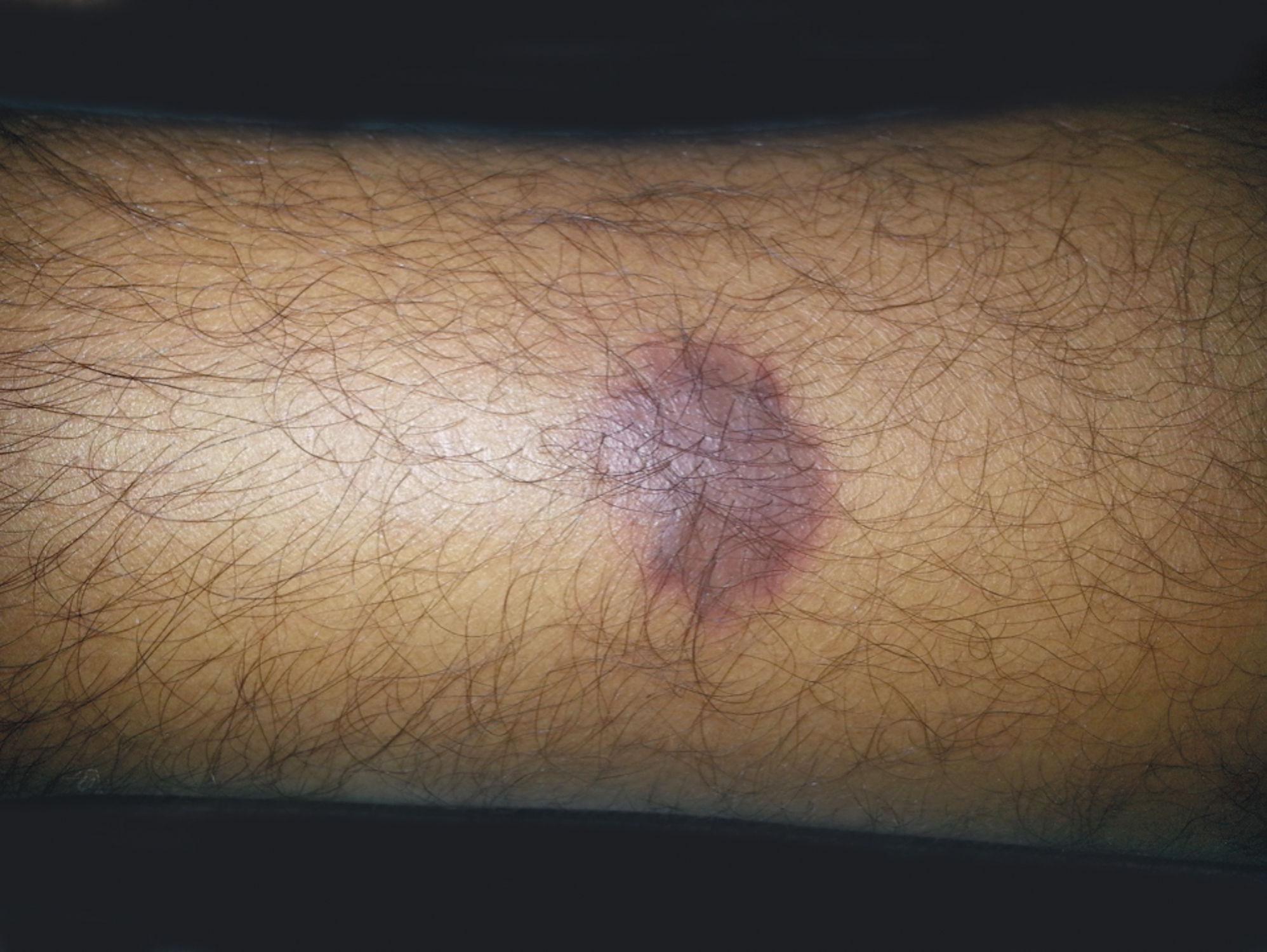 Kaposi’s sarcoma in persons living with HIV/AIDS: a case series in a ...