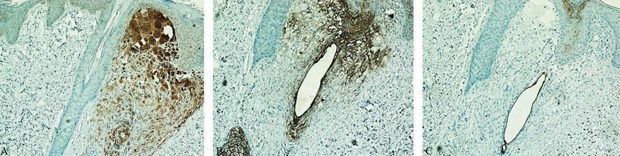 Fox-Fordyce disease: report of two cases with perifollicular ...