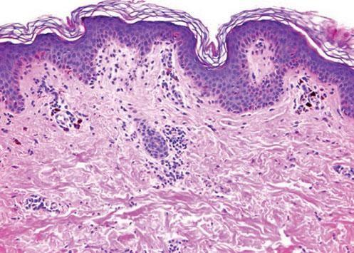 Autoimmune progesterone dermatitis manifesting as generalized fixed ...