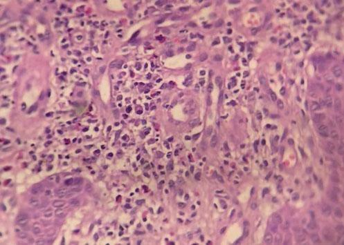 Thalidomide in plasma cell balanitis refractory to conventional topical ...