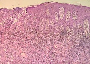 Thalidomide in plasma cell balanitis refractory to conventional topical ...
