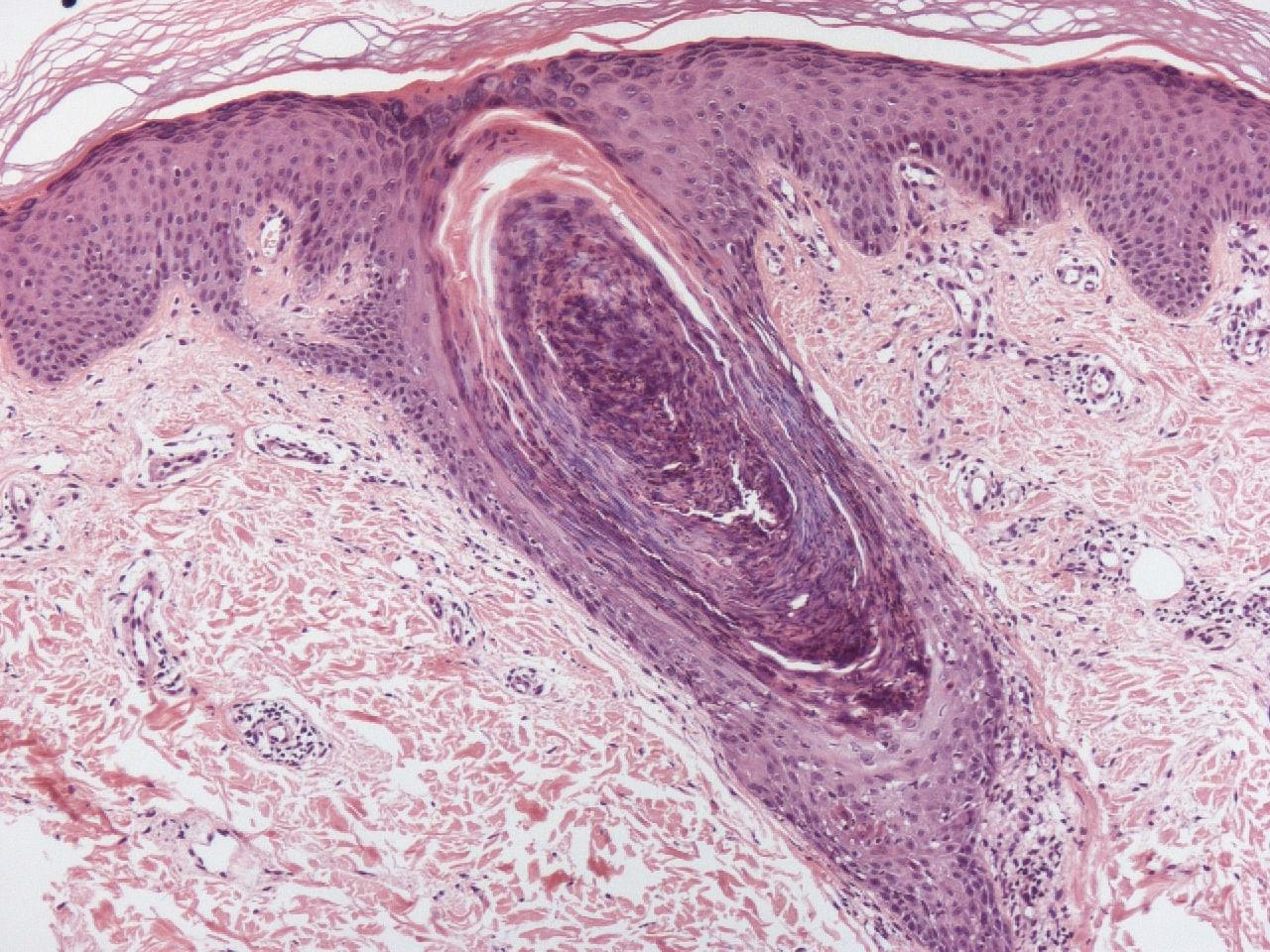 Follicular psoriasis: an underdiagnosed entity?* | Anais Brasileiros de ...