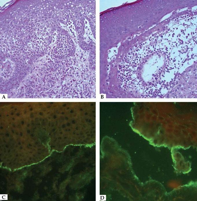 Bullous pemphigoid* | Anais Brasileiros de Dermatologia