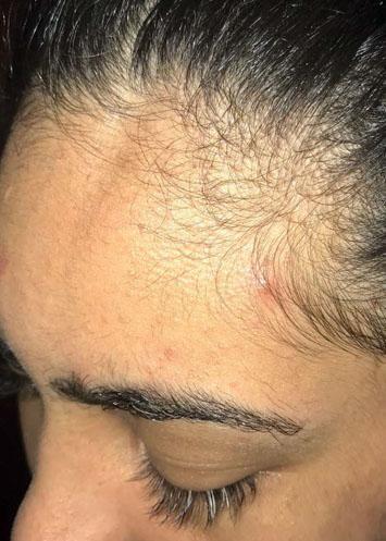 Linear Scleroderma Forehead