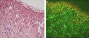 Diagnostic approach of eosinophilic spongiosis | Anais Brasileiros de ...