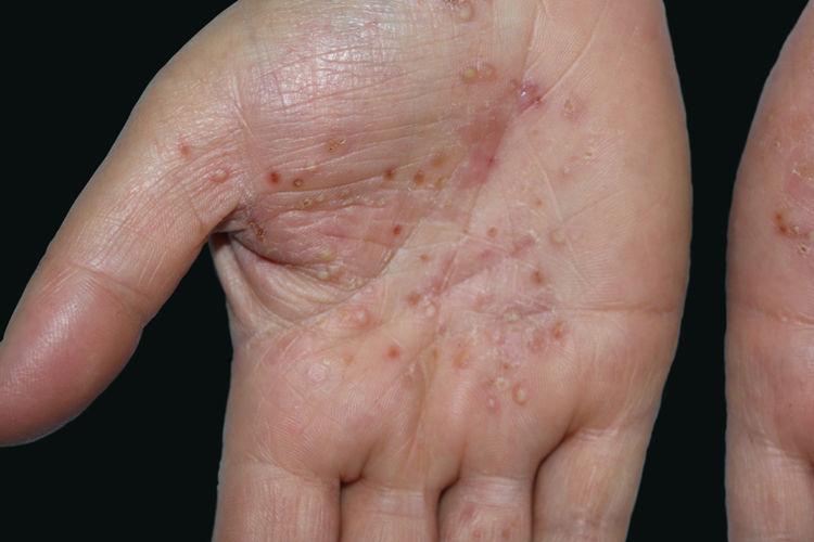 Clinical characteristics and associations of palmoplantar pustulosis ...