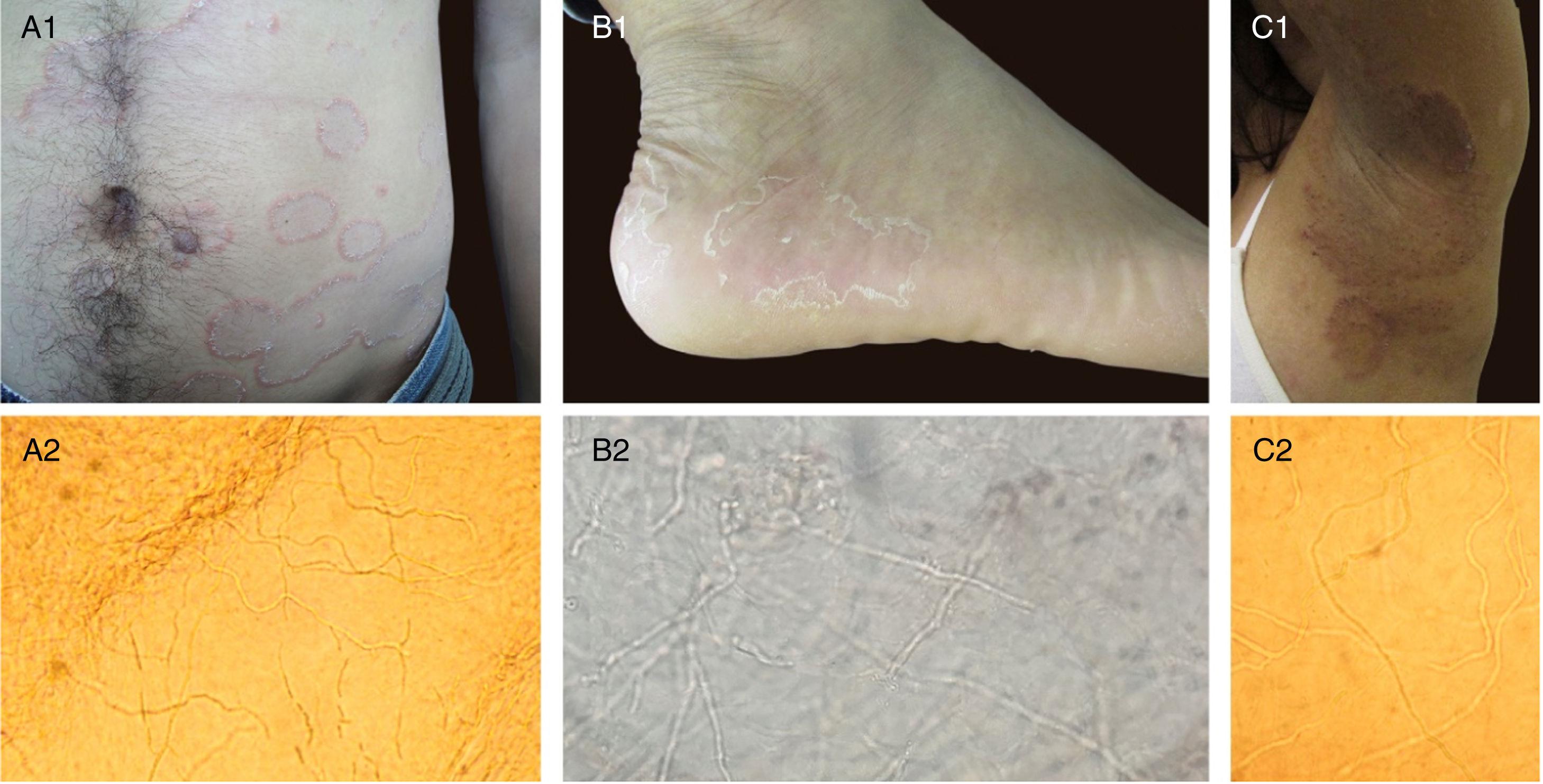 Beware of reflectance confocal microscopy artifacts when searching ...