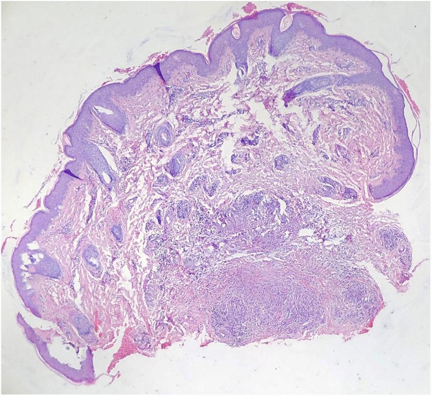 Chondrodermatitis Nodularis Helicis Histology