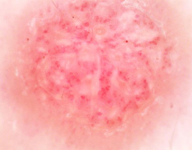 The string of pearls pattern in dermoscopy of a chest papule | Anais ...