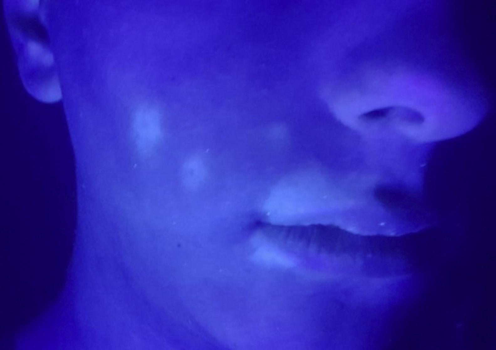 Inflammatory segmental vitiligo during oral isotretinoin use: a casual ...